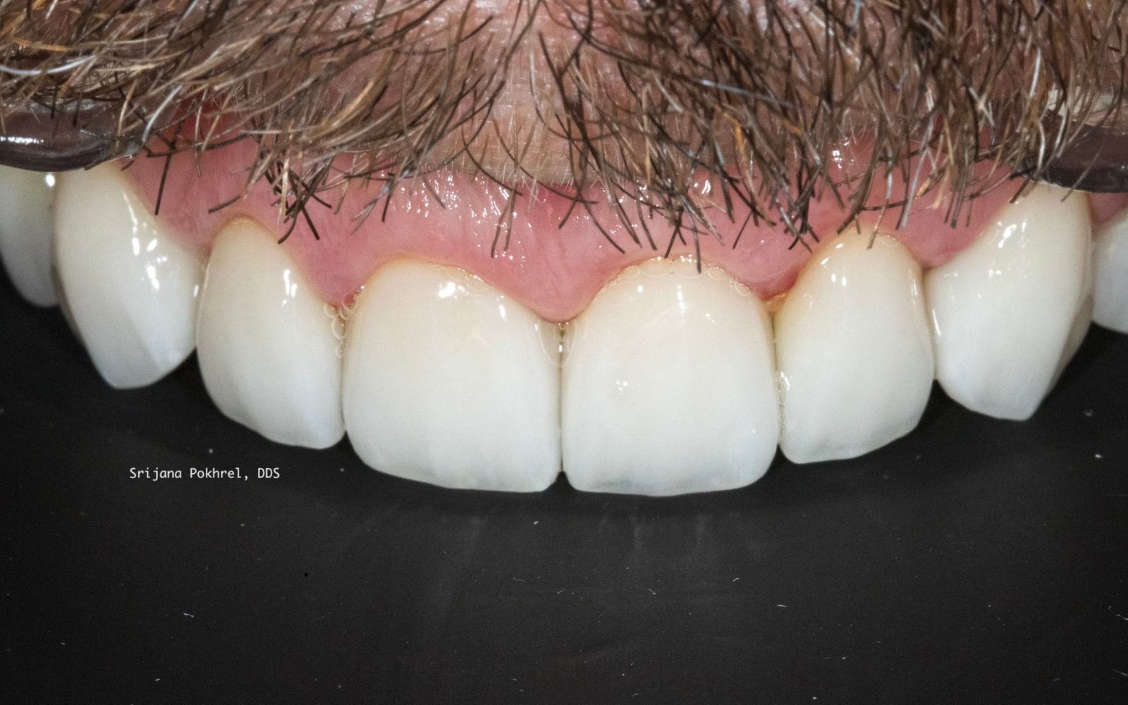 Invisalign in San Francisco and Mountain View