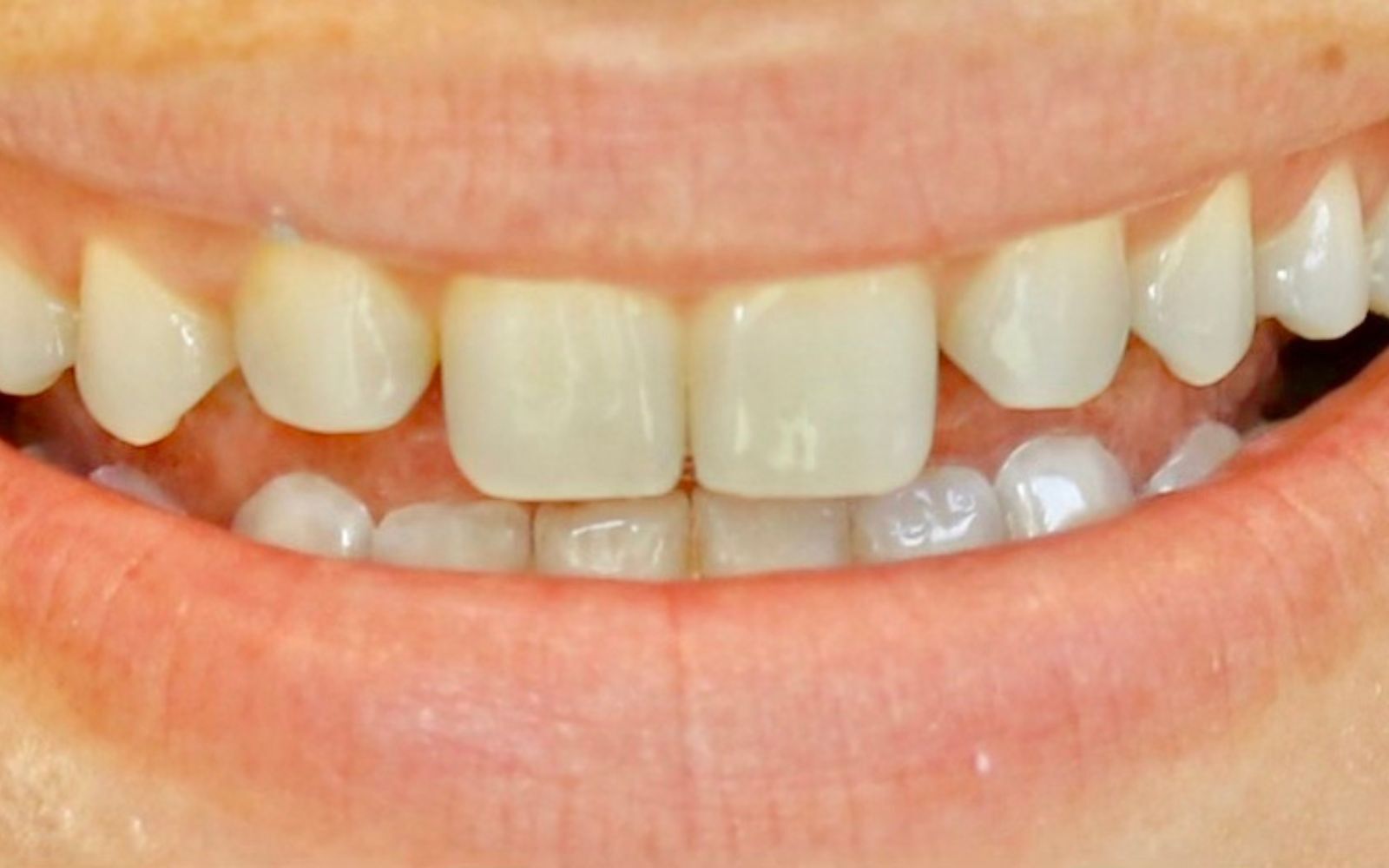 Invisalign in San Francisco and Mountain View
