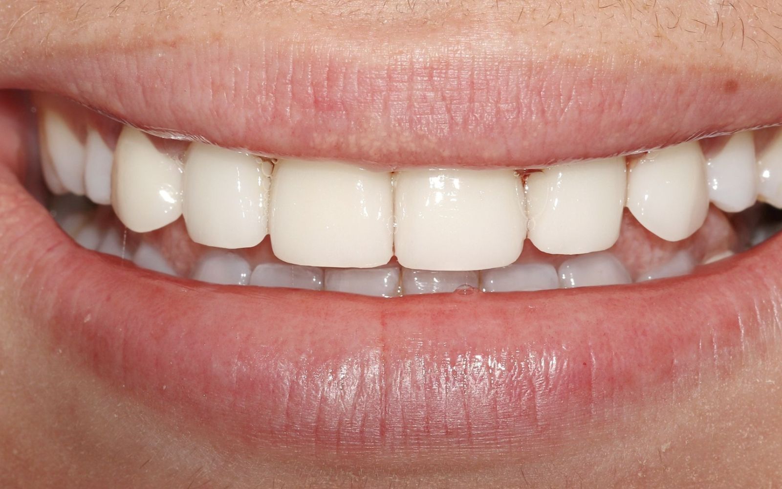 Invisalign in San Francisco and Mountain View