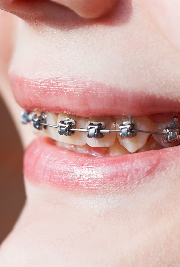 Braces in Kyle, TX | Kyle Orthodontics