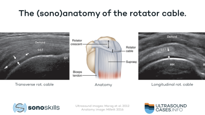 The anatomy of the rotator cable linked to tendon pathology