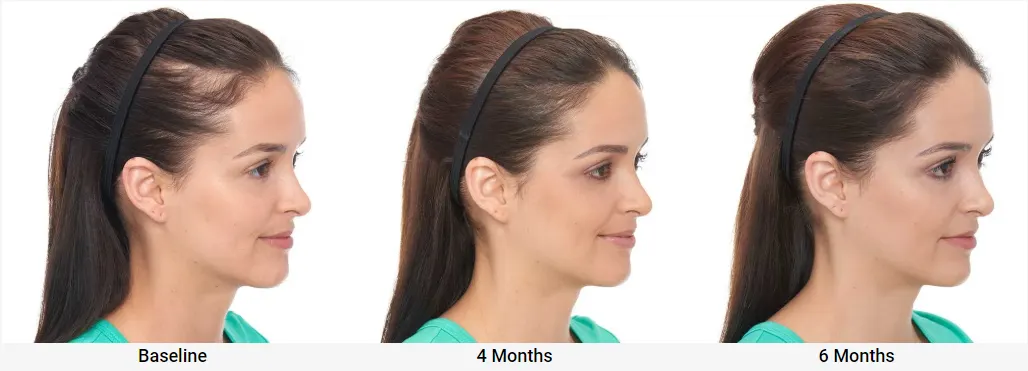 How Minoxidil Works to Regrow Hair | Hair Club