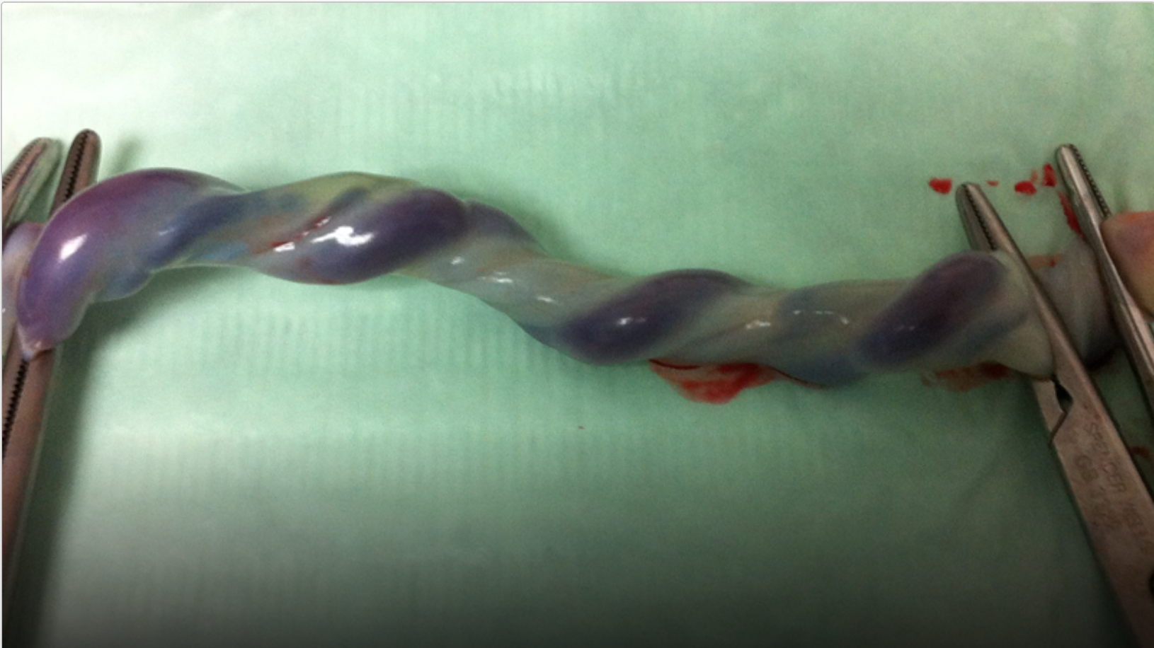 Umbilical Cord Prolapse | Emergency Care Course | Kineo Courses