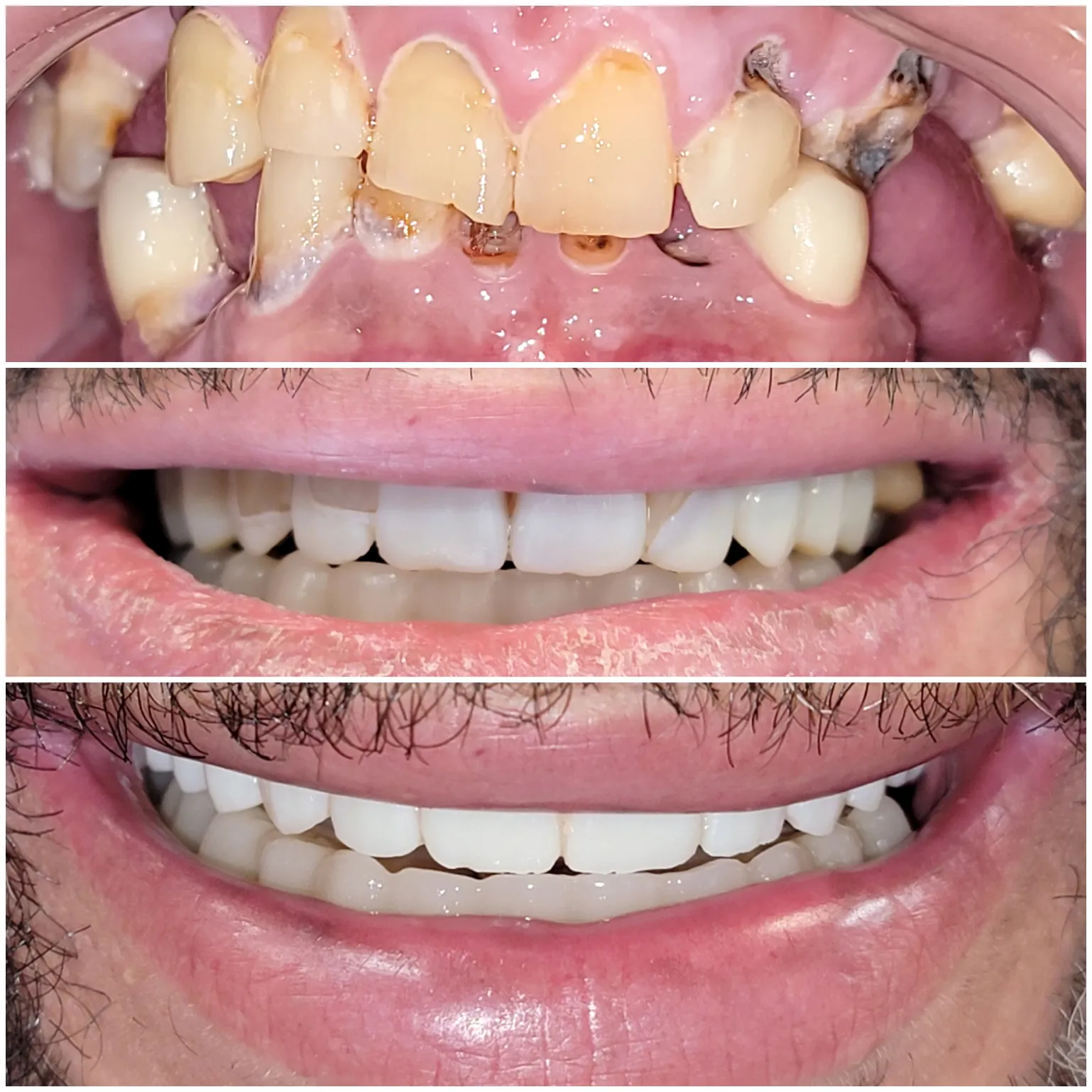 Snap-in Dentures in Wesley Chapel, FL | Snap-In Tooth Replacement