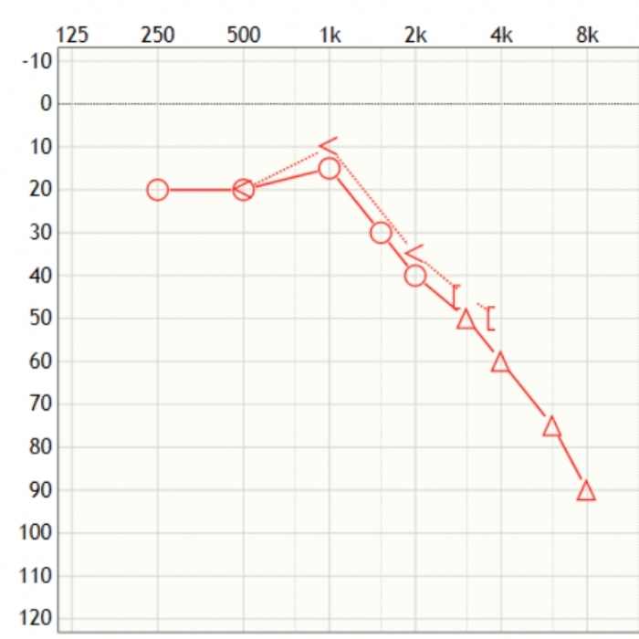 High-Frequency Hearing Loss | Causes, Treatments, Prevention