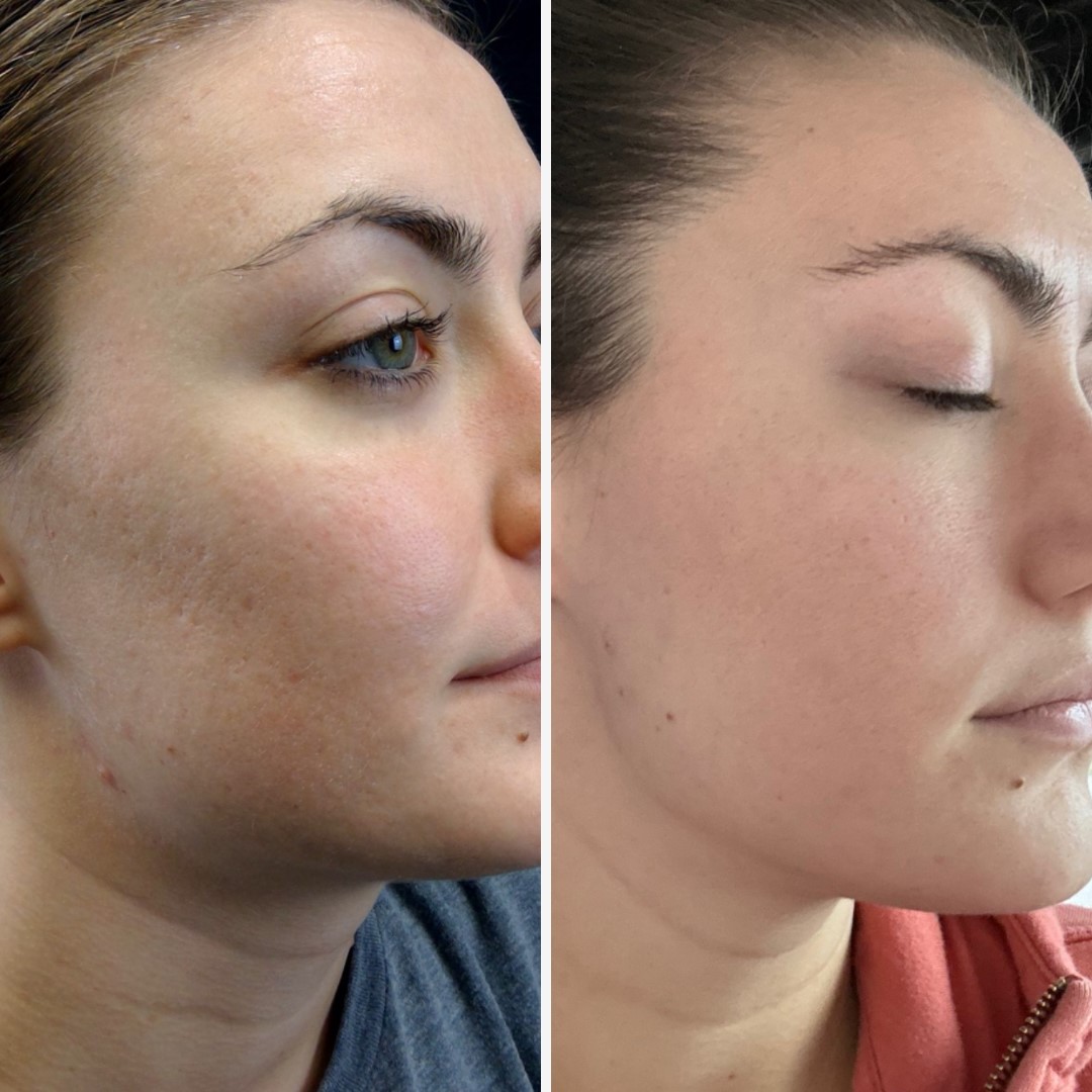 SkinStylus® Microneedling