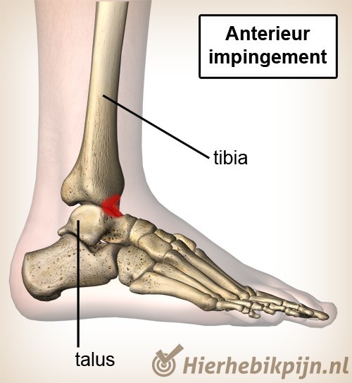 Anterieur Enkel Impingement | PhysiqCare Encyclopedie