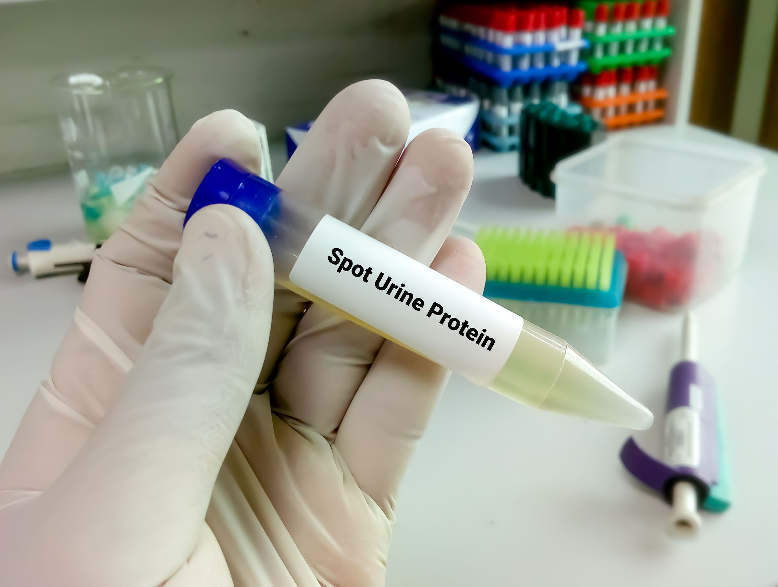 Protein in Urine: Causes and Symptoms