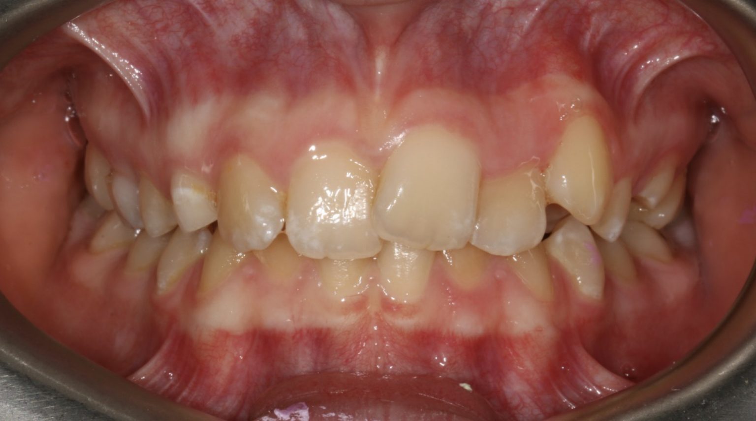 Carii dentare - Tipuri, Cauze & Tratament | Angelescu Dental Clinic