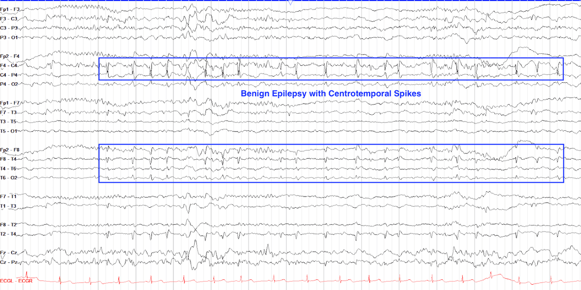 EEG Fun Facts: Rolandic Spikes | Feb 24, 2023