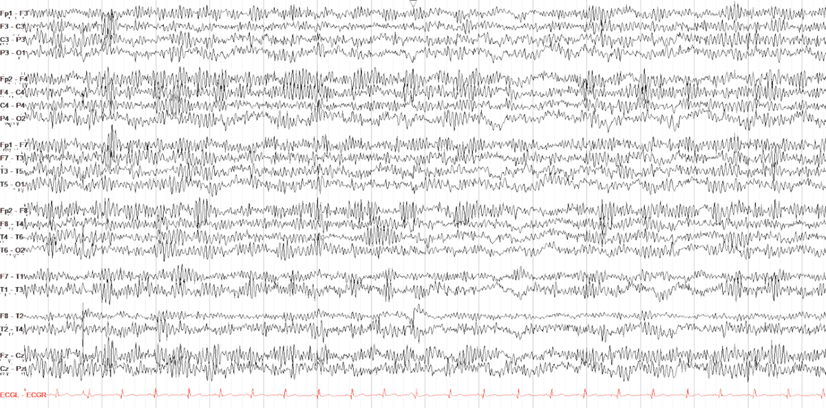 EEG Fun Facts: Beta | Jun 16, 2023