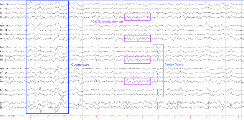 EEG Fun Facts: Vertex Sharp Wave Transients | May 26, 2023