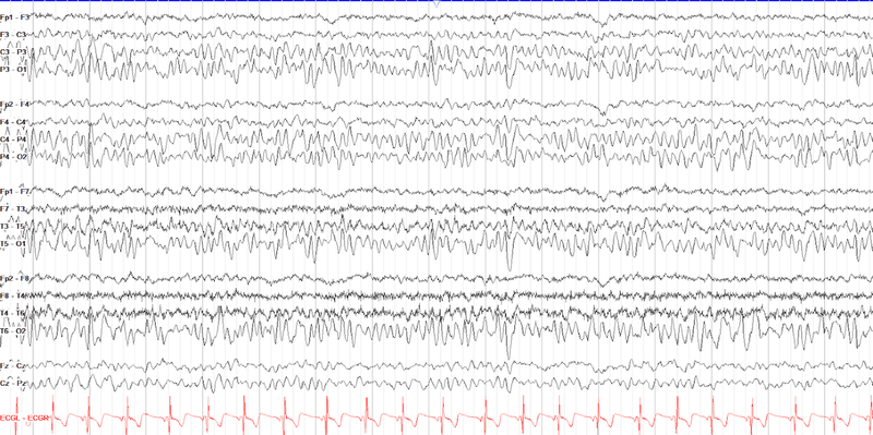 EEG Fun Facts: Posterior Slow Waves of Youth | May 05, 2023