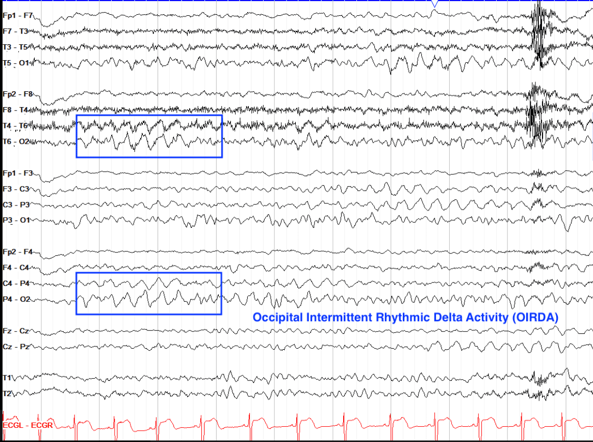 EEG Fun Facts: Delta | Sep 08, 2023