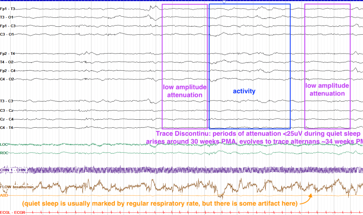EEG Fun Facts: Quiet Sleep | Aug 19, 2023