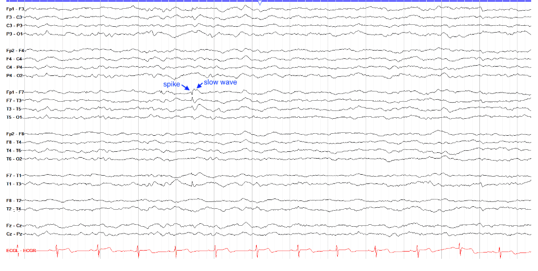 EEG Fun Facts: Spike Wave | Jun 08, 2023