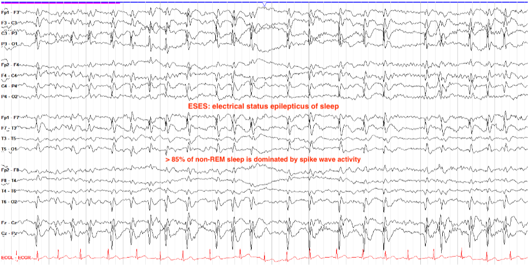 EEG Fun Facts: ESES | Jul 28, 2023
