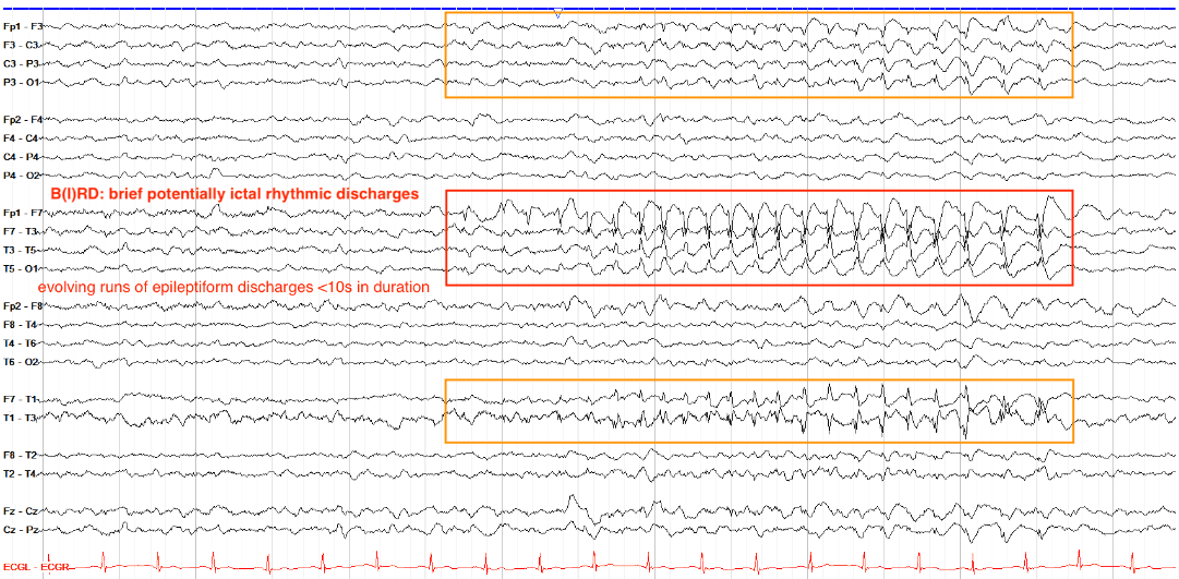EEG Fun Facts: B(I)RDs | Sep 22, 2023
