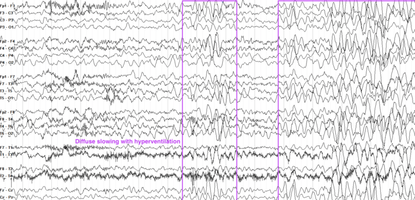EEG Fun Facts: HIHARS | Oct 06, 2023