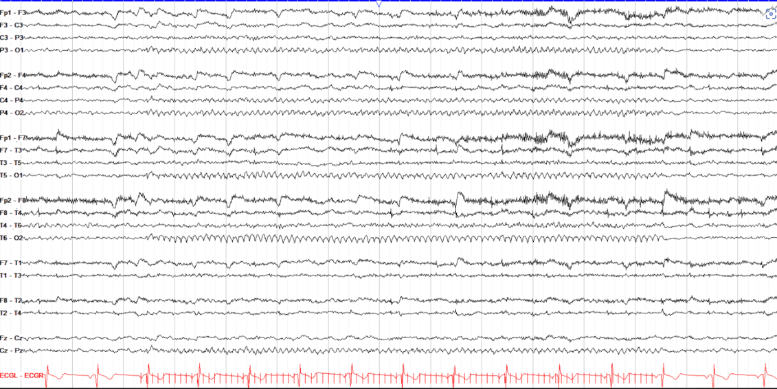 EEG Fun Facts: Photic Driving | Oct 20, 2023