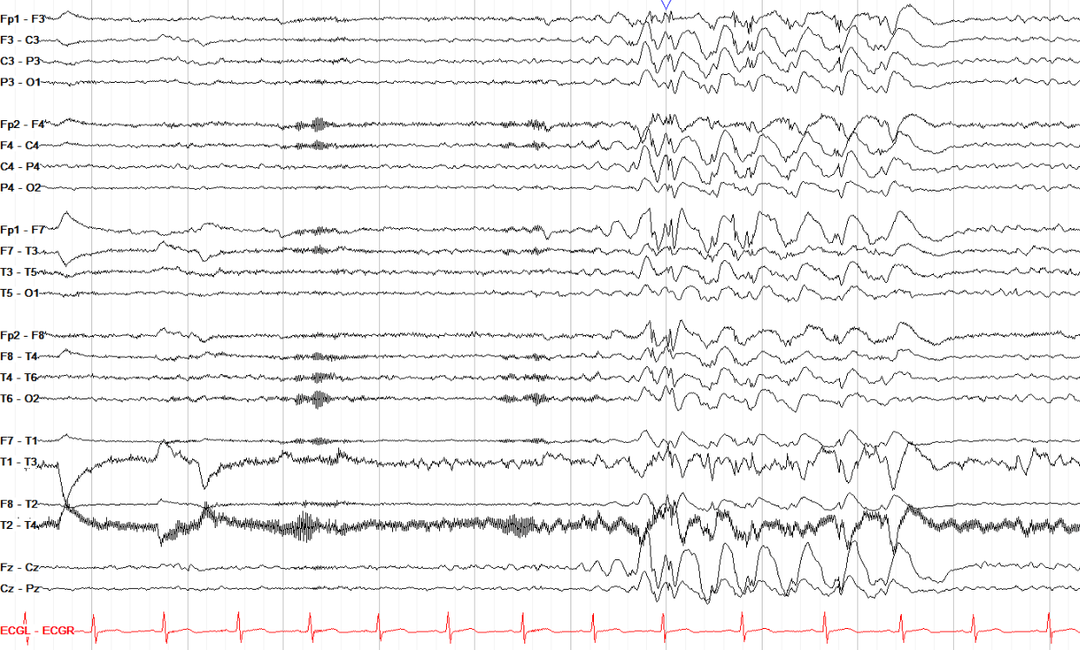 EEG Fun Facts: IED’s | Oct 27, 2023