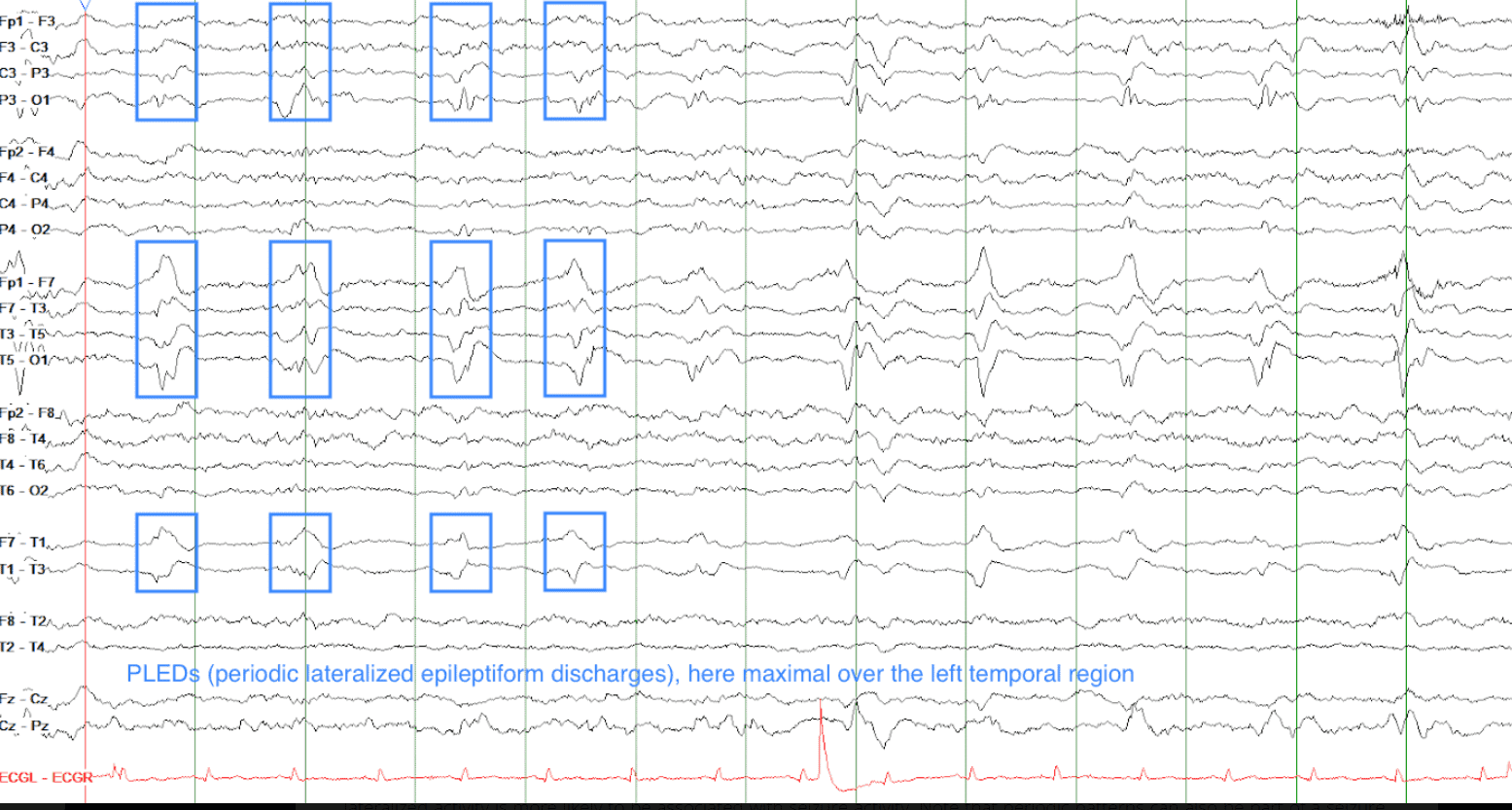 EEG Fun Facts: Lateralized Periodic Discharges! | Dec 08, 2023