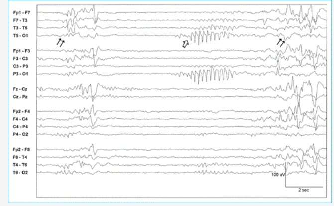 EEG Fun Facts: Temporal THETA Bursts! | Dec 22, 2023