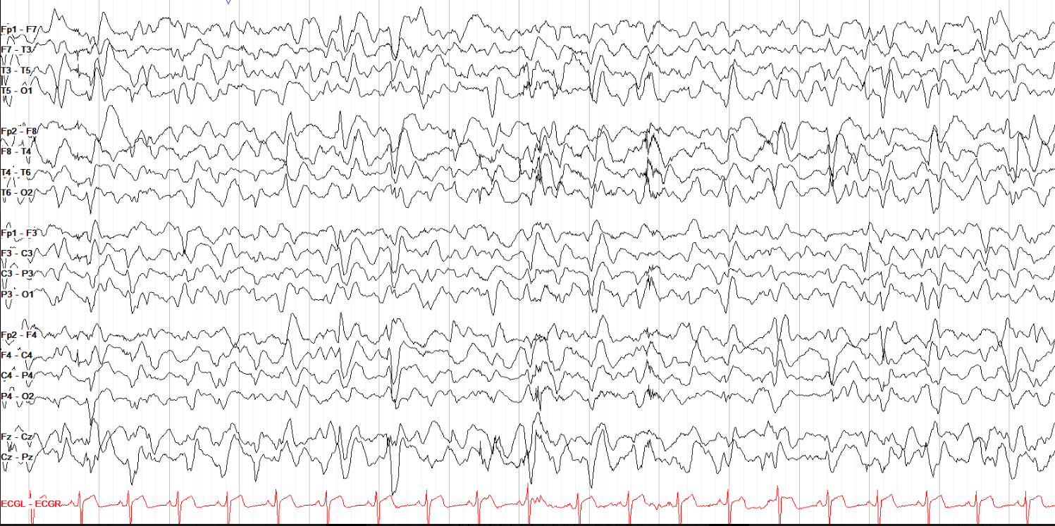 EEG Fun Facts: Slow Spike and Wave (SSW) Complexes | Dec 29, 2023