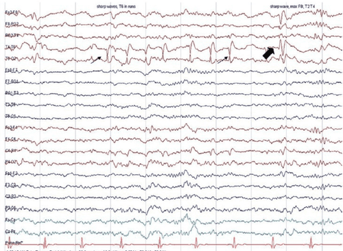 EEG Fun Facts | New Every Friday | Neuro Pathway