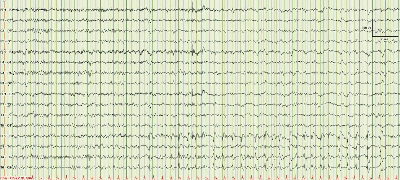 EEG Fun Facts: Seizures and Epilepsy: Temporal Lobe | Feb 16, 2024