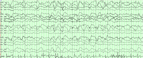 EEG Fun Facts: Angelman’s Syndrome | May 03, 2024