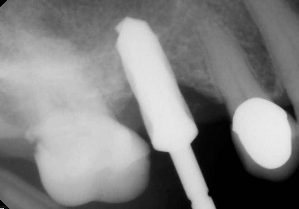 Case Study: First Maxillary Right Molar Crestal Sinus Lift With ...