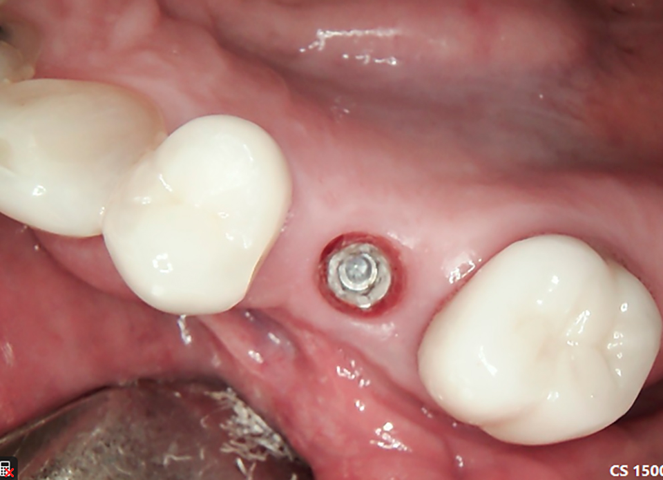 Case Study: First Maxillary Right Molar Crestal Sinus Lift With ...