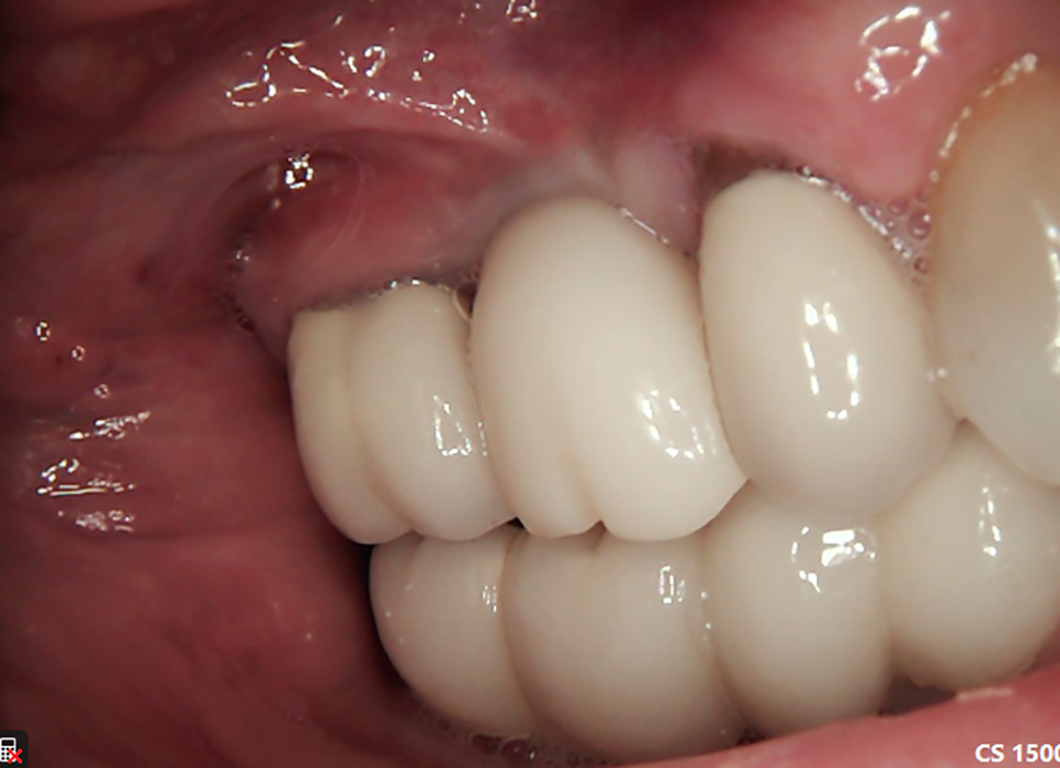 Case Study: First Maxillary Right Molar Crestal Sinus Lift With ...