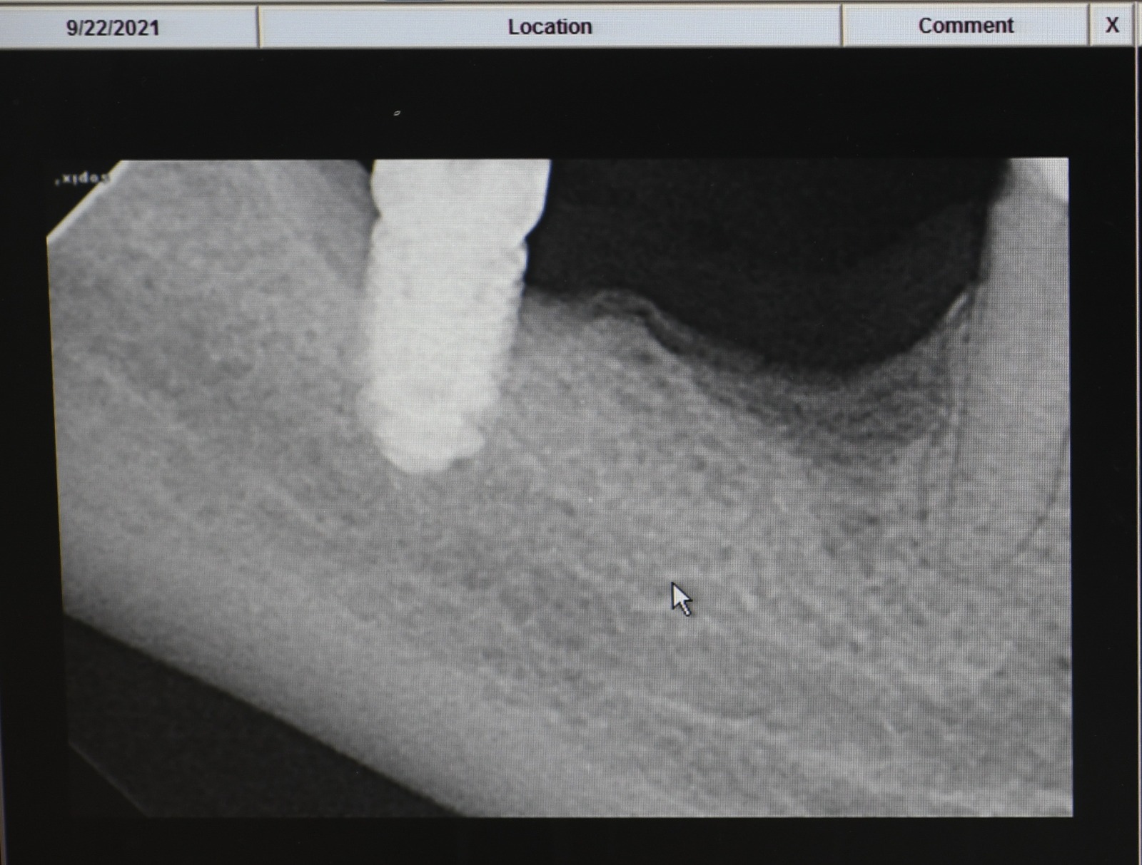 Case Study: Use Of Bone Rings For Vertical Augmentation Of The Distal ...