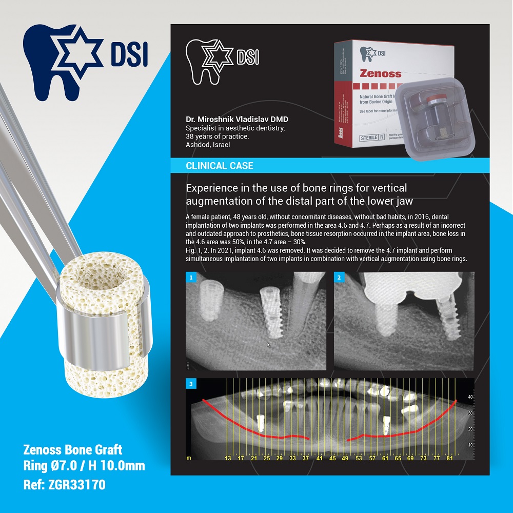 Case Study: Use Of Bone Rings For Vertical Augmentation Of The Distal ...