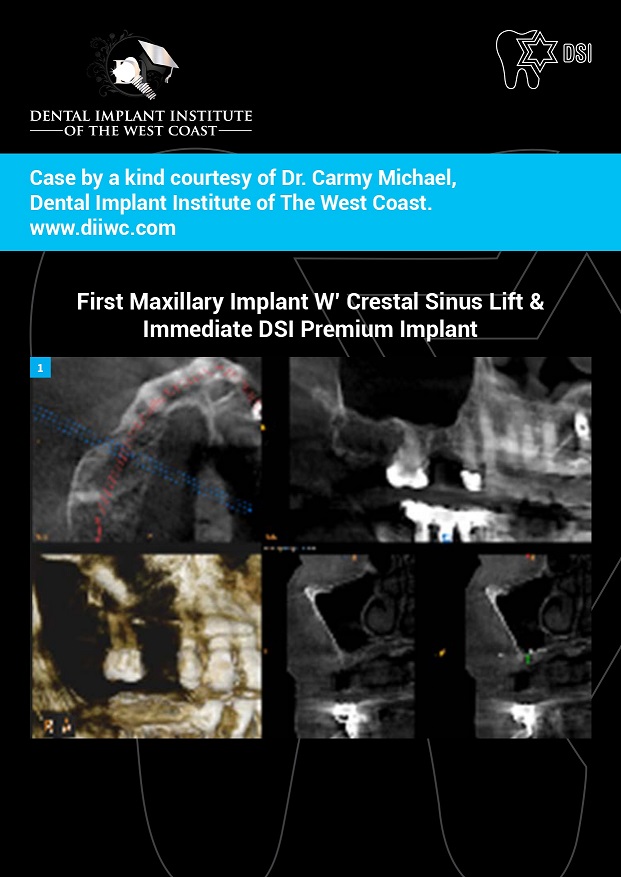 Case Study: First Maxillary Right Molar Crestal Sinus Lift With ...