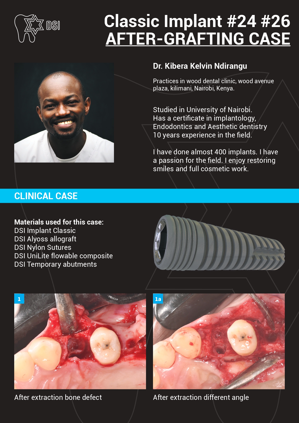 Case Study: Bone Restoration Using Allograft And Classic Implant ...