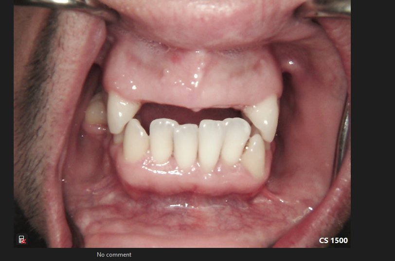 Case Study: Narrow Anterior Maxillary Ridge Expansion Grafting | DSI