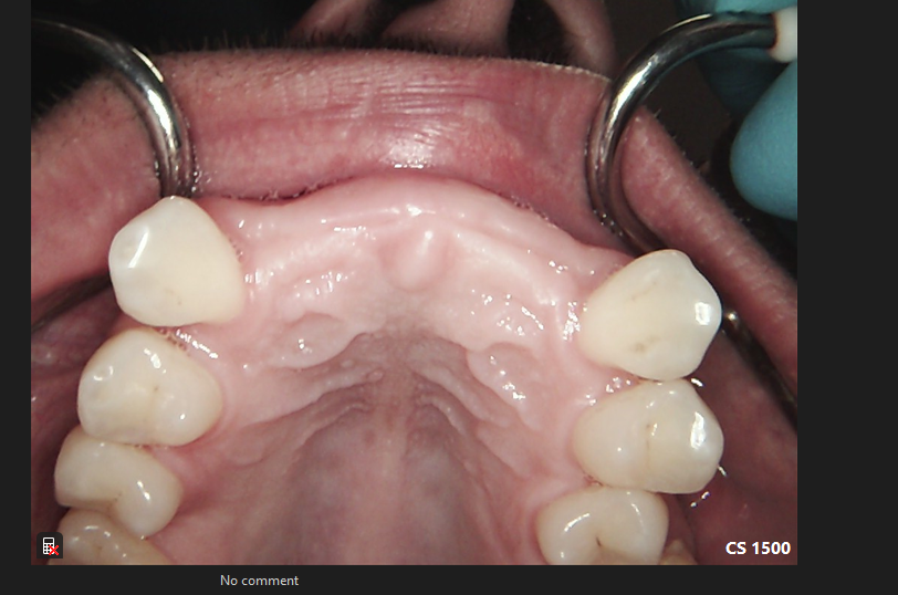 Case Study: Narrow Anterior Maxillary Ridge Expansion Grafting | DSI