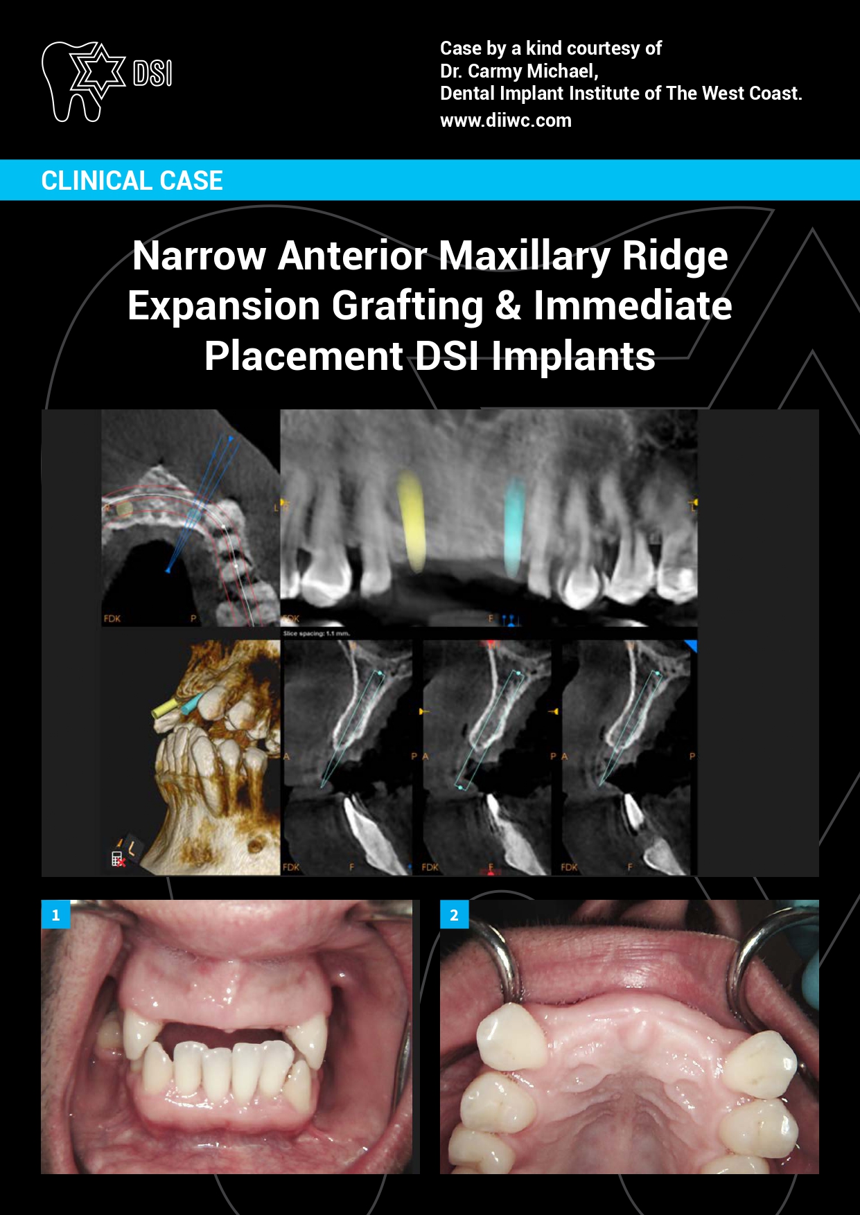 Case Study: Narrow Anterior Maxillary Ridge Expansion Grafting | DSI