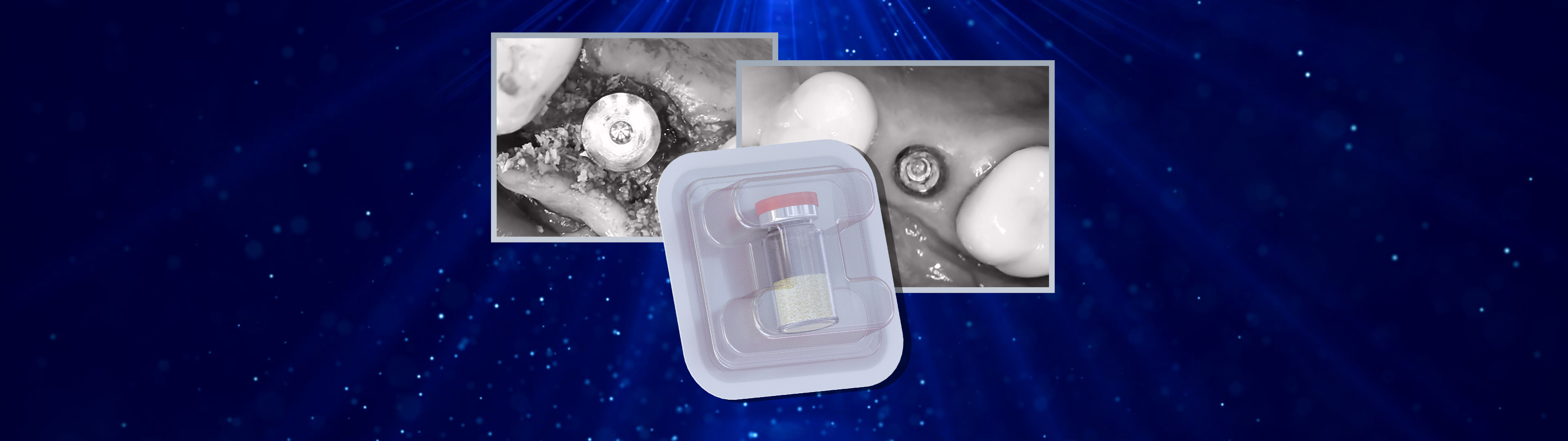 Case Study: First Maxillary Right Molar Crestal Sinus Lift With ...