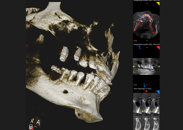 Case Study: Sinus Implantation with Ridge Expansion | DSI