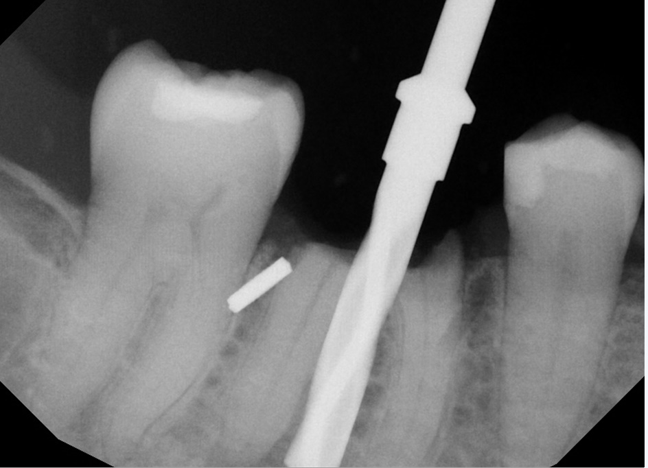 Case Study: Septum implant loading using DSI Top Drill kit case | DSI