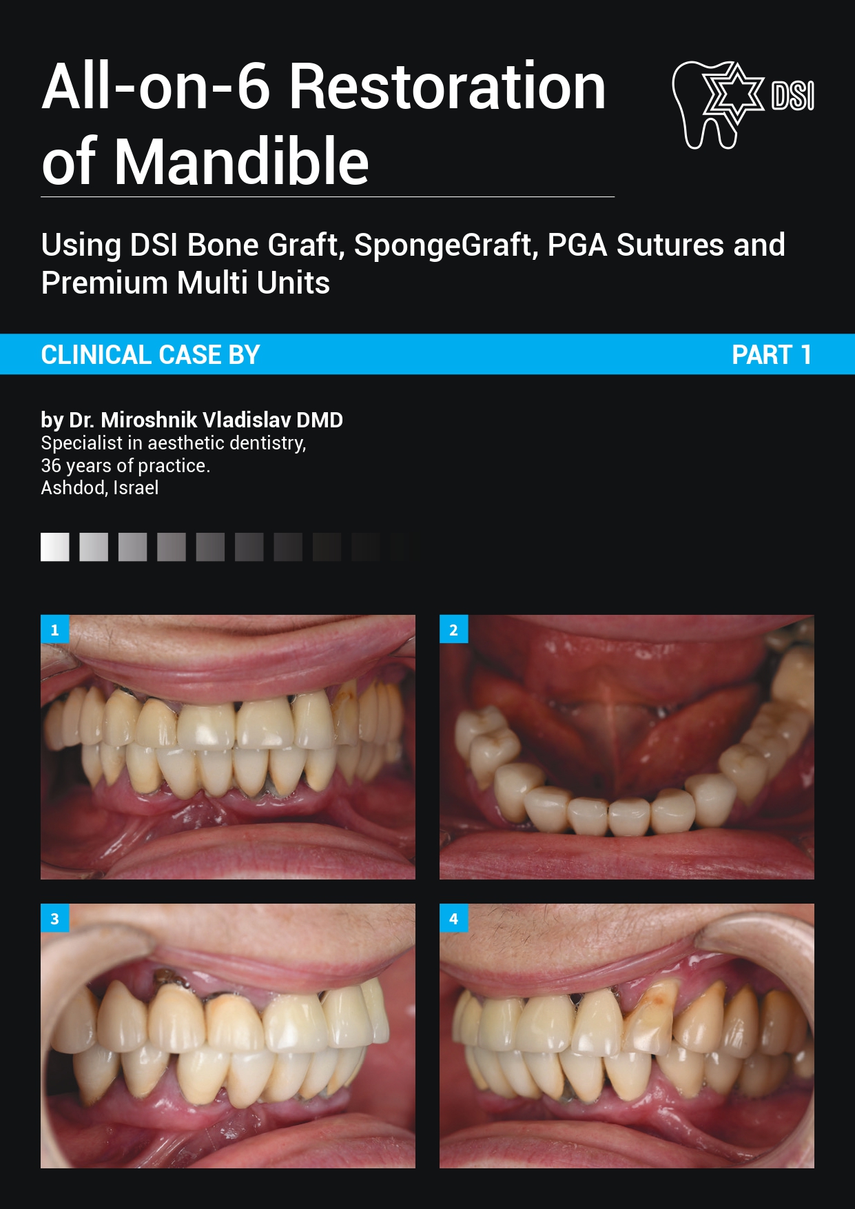 Case Study: All-on-6 Restoration of Mandible clinical case | DSI