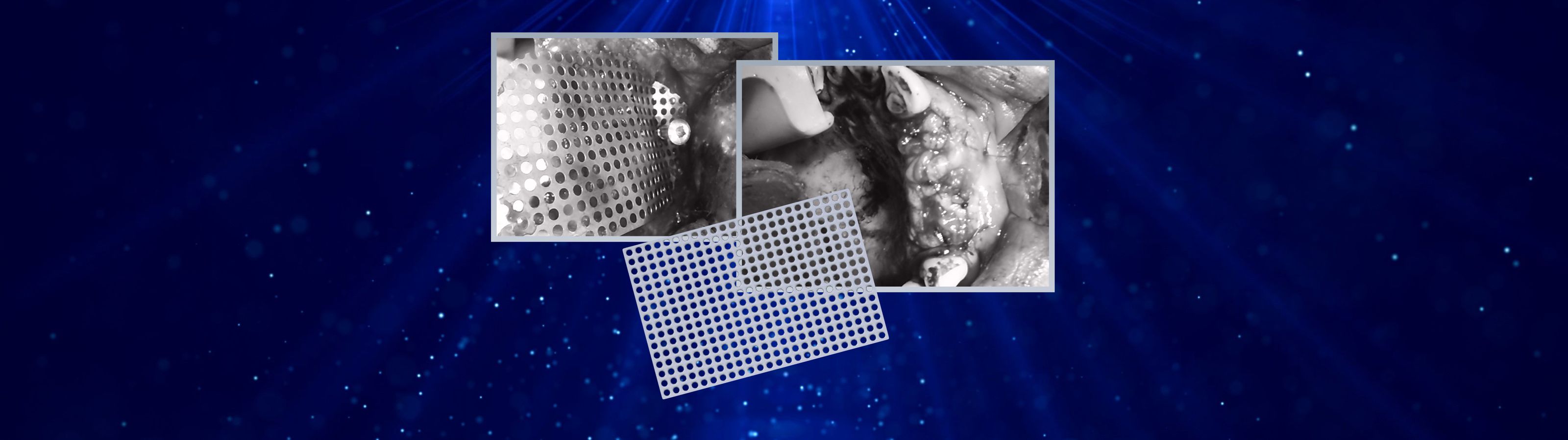 DSI Titanium Mesh Membrane | DSI Dental Solutions