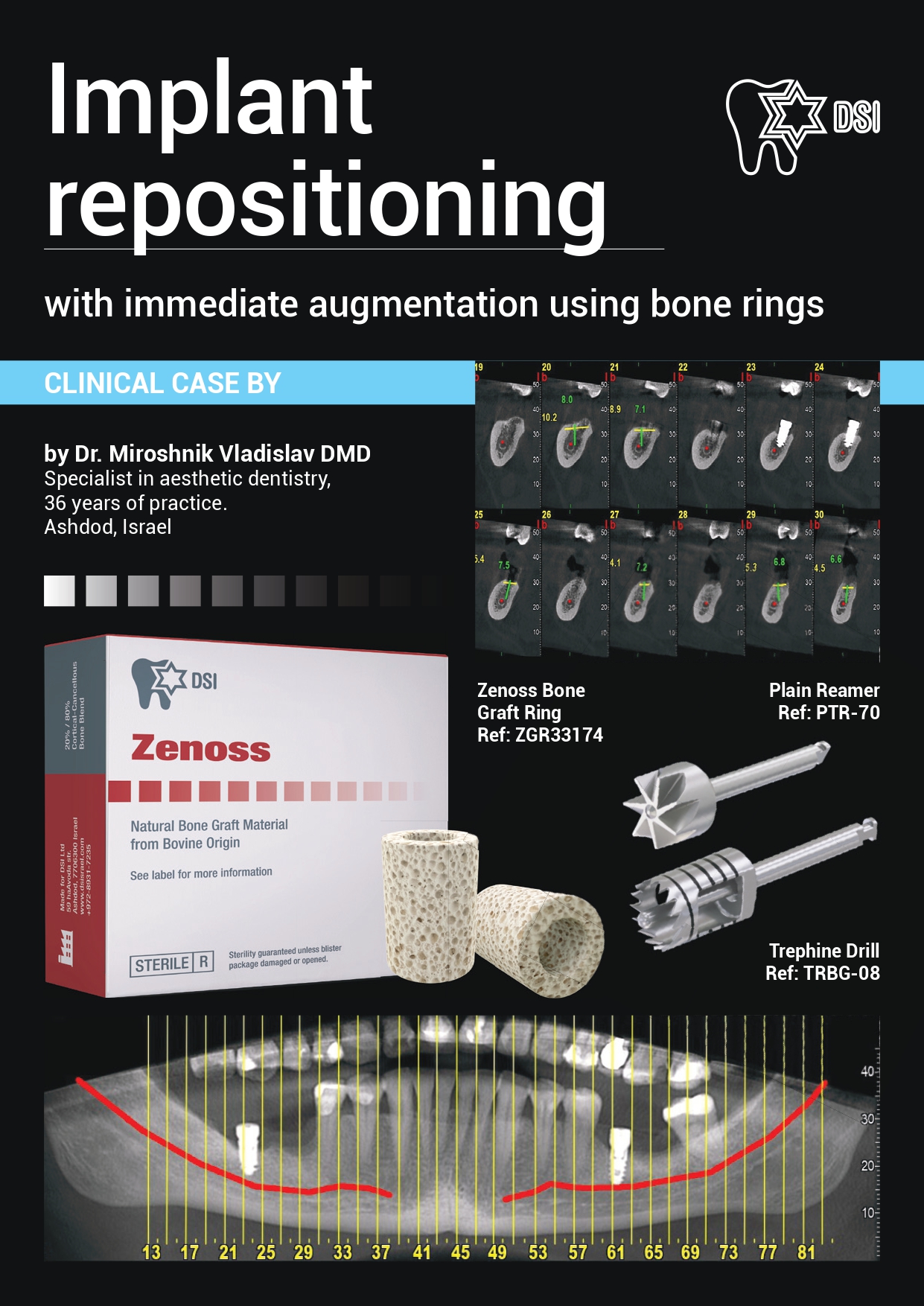 Case Study: Implant Repositioning with immediate augmentation using ...