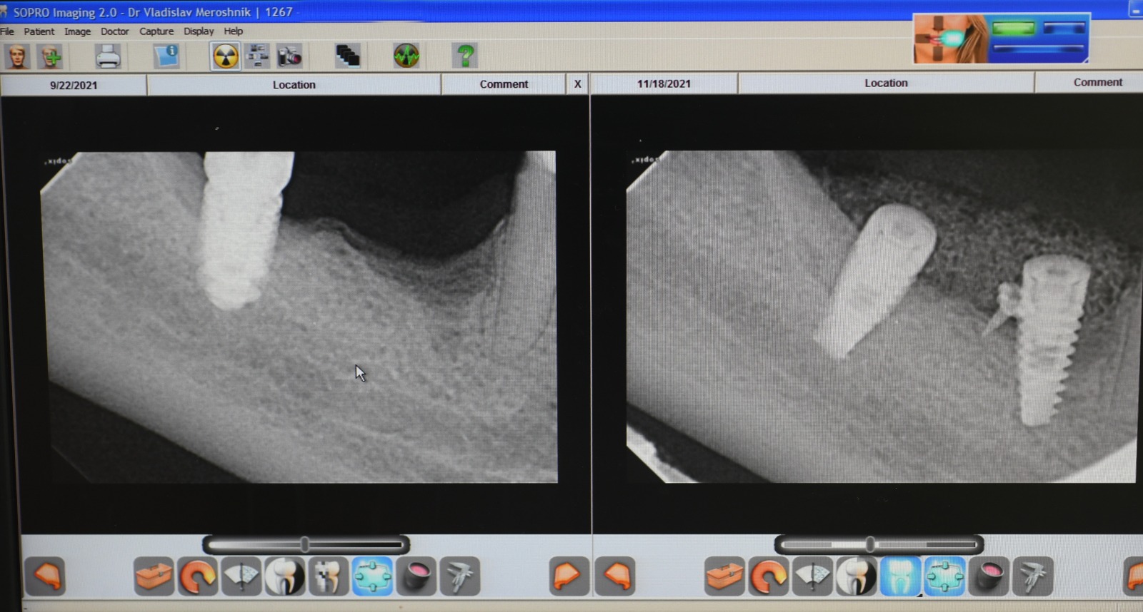Case Study: Implant Repositioning with immediate augmentation using ...