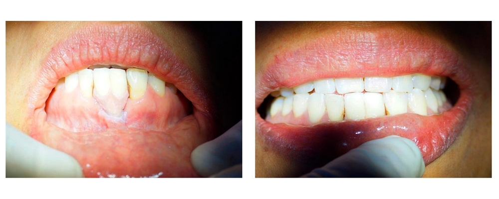 Case Study: Double Central Teeth Restoration in Mandibular Area | DSI