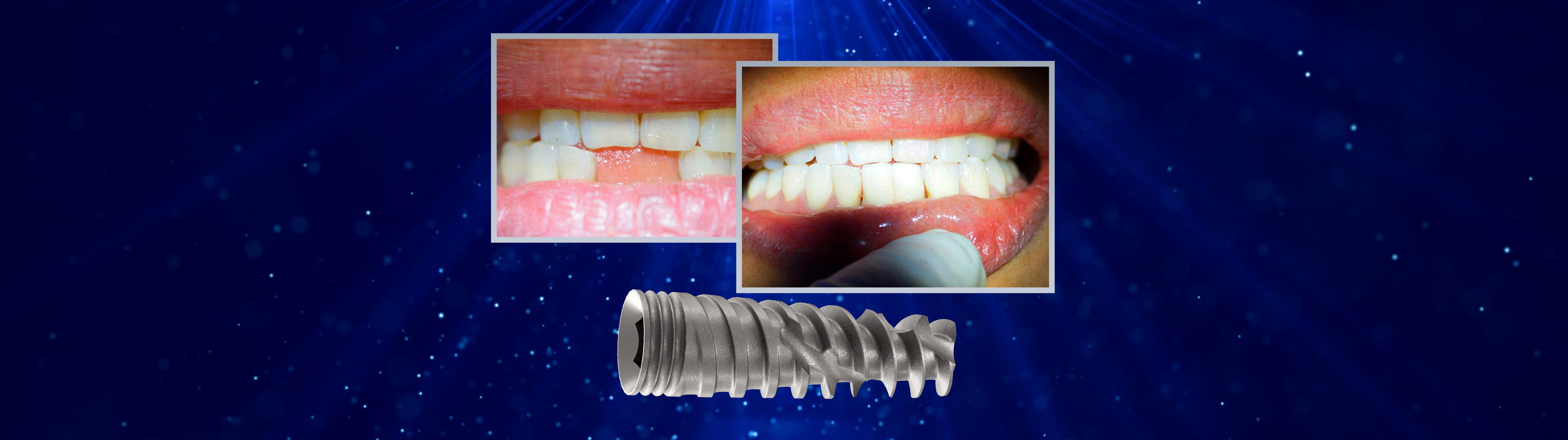 Case Study: Double Central Teeth Restoration in Mandibular Area | DSI